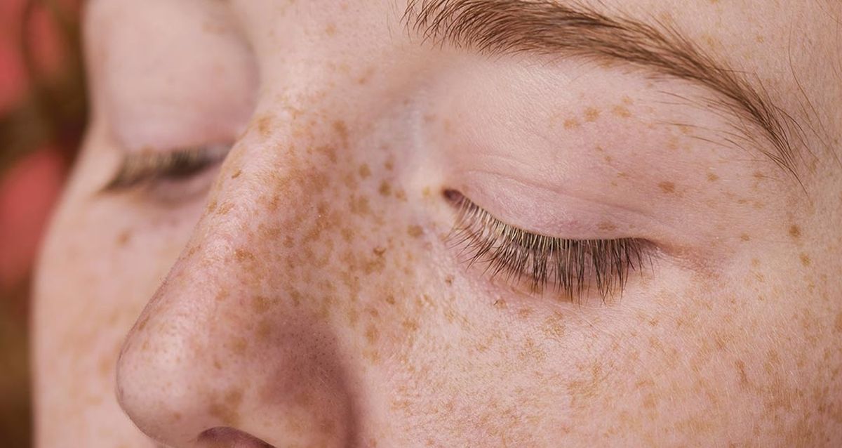 Tipos de pintas e sinais na pele: quando devo me preocupar? - Blog da Alice