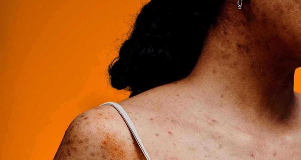 Toda pinta é cancerígena? Saiba quando se preocupar - Blog da Alice