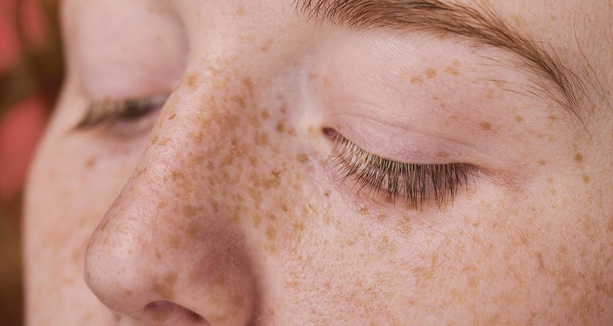 Tipos de pintas e sinais na pele: quando devo me preocupar? - Blog da Alice